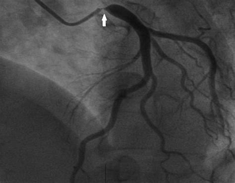 Syphilitic Coronary Artery Ostial Stenosis Presenting With Acute