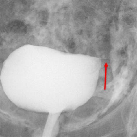 This Cystography Shows No Leakage After Injection Of Nbca Red Arrow
