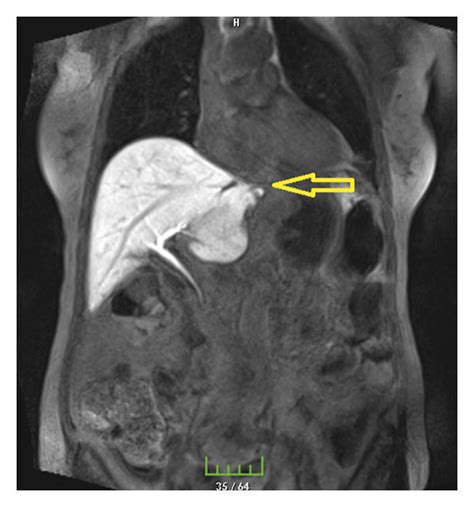 Mrcp Imaging Bile Leakage Is Shown In The Left Triangular Ligament Download Scientific Diagram