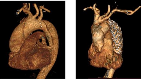 One Stage Total Repair Of An Acute Type A Aortic Dissection With Total