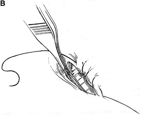 After A Vertical Incision A Skin Flaps Have Been Elevated And Download Scientific Diagram
