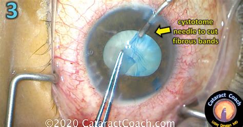 Specialized Techniques Can Deal With Fibrotic Lens Capsule In Cataract