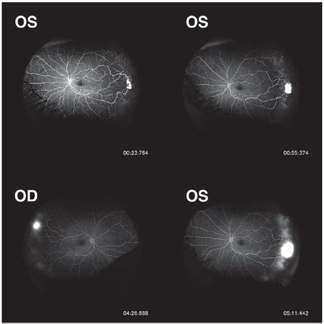 Early And Late Phase Fluorescein Angiography Of The Left Eye Showing Download Scientific