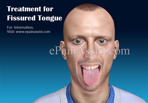 Fissured Tongue Causes Signs Symptoms Treatment