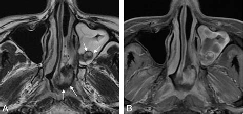 Figure 1 From Mr Evaluation Of Sinonasal Angiomatous Polyp Semantic