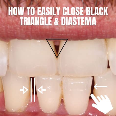 Dentistry Compositebonding Varistrip Dre Composite Course