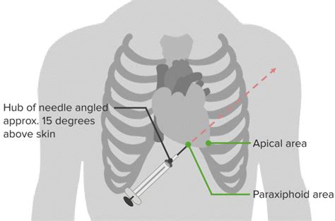 Pericardial Effusion And Cardiac Tamponade — Symptoms And Ecg