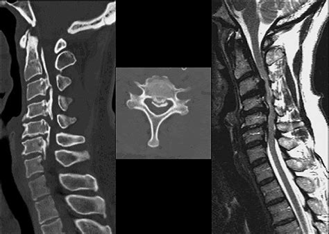 Imaging Spinal Stenosis Applied Radiology