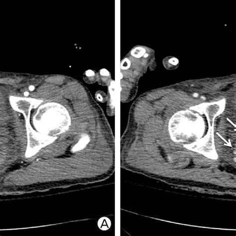 Ct Angiography Demonstrates No Active Contrast Extravasation To The Download Scientific Diagram