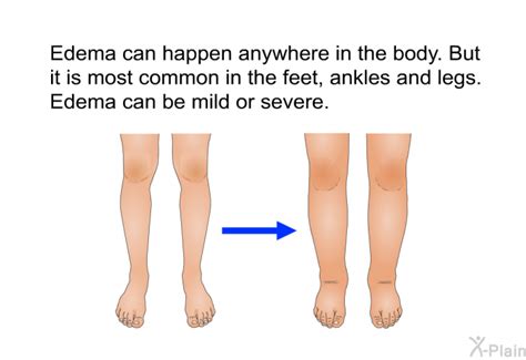 Edema Can Best Be Observed In Detroit Chinatown