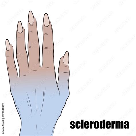 Vetor De Scleroderma A Chronic Disease Of Women Makes The Skin Thick