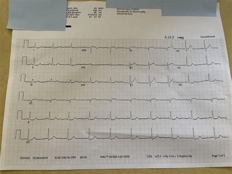 Peaked T Waves 1 Hour Before Stemi Rekgs Peaked T Waves 1 Hour Before Stemi Rekgs