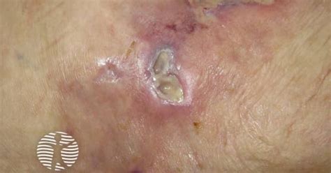 Calciphylaxis Image