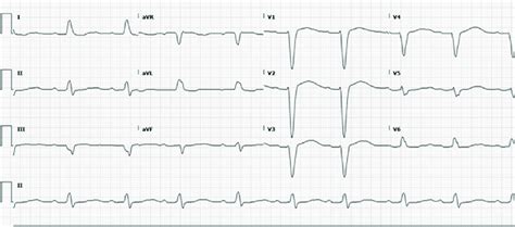 Severe QTc Prolongation New LBBB LBBB Left Bundle Branch Block