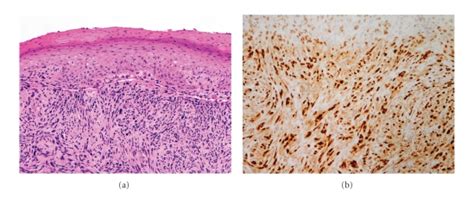 Spindle Cell Sarcomatoid Squamous Cell Carcinoma A The