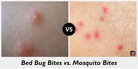 Difference Between Bed Bug Bites And Mosquito Bites Bed Bug Bites Bed Bugs Bug Bites