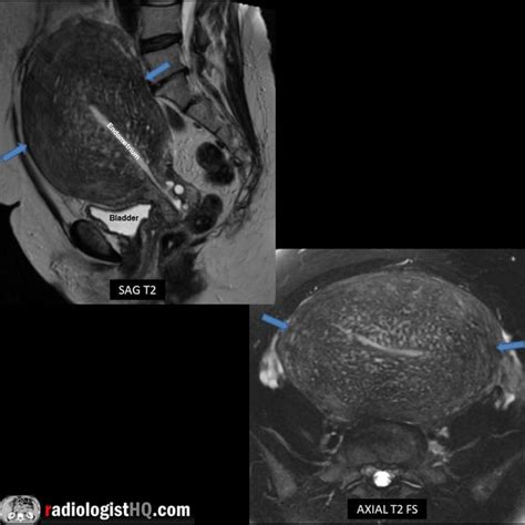 Severe Uterine Adenomyosis On Mri R Radiology
