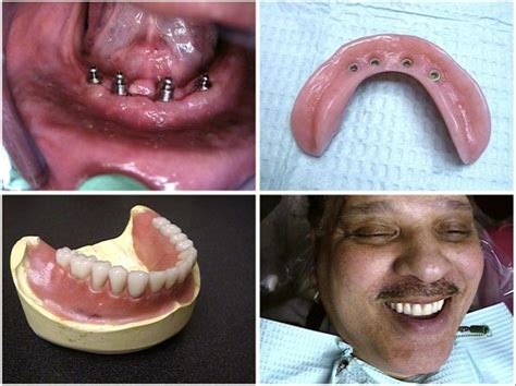 Denture O Rings At Patrice Hassinger Blog