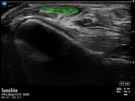 Foot And Ankle Anterior Recess Extensor Digitorum Longus Image Sonosite Institute For Point Of