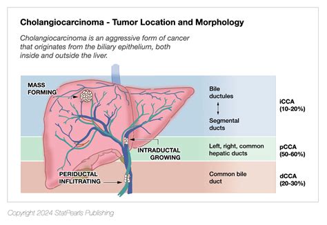 Cholangiocarcinoma Bile Duct Cancer Md Searchlight