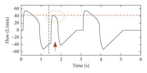 Ventilator Waveforms Of Autotriggering Download Scientific Diagram