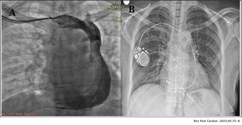 Placement Of Permanent Pacemaker In A Patient With Venous Anomaly Through The Right Subclavian