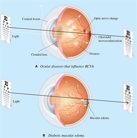 Frontiers Deep Learning To Infer Visual Acuity From Optical Coherence Tomography In Diabetic