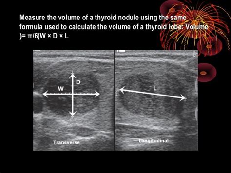 Thyroid Ultrasound