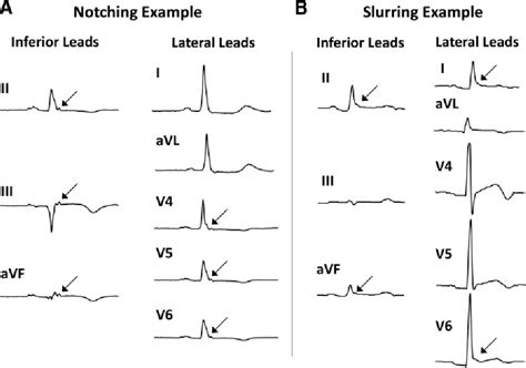 Figure 1 From Early Repolarization Associated With Ventricular