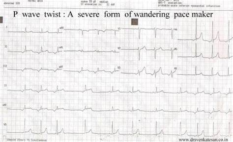 Wandering Pacemaker Drsvenkatesan Md