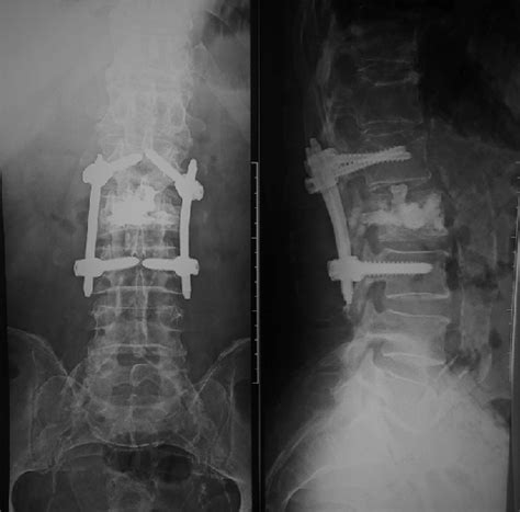 Why Can T You Bend After Spinal Fusion At Hamish Gellatly Blog