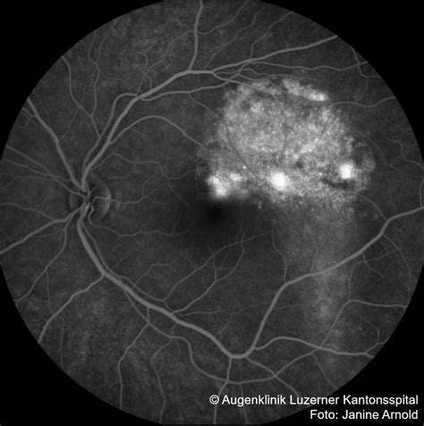 Central Serous Chorioretinopathy Cscr