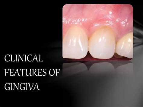 Clinical Features And Stages Of Gingivitis Pptx