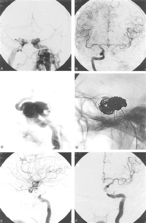 Patient 6 Ruptured Left Cavernous Sinus Aneurysm In A 70 Year Old Download Scientific Diagram