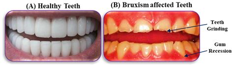 Understanding Clenching And Grinding Bruxism