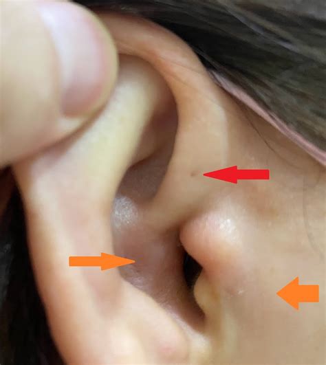 Preauricular Sinus Infection Uni Clinic