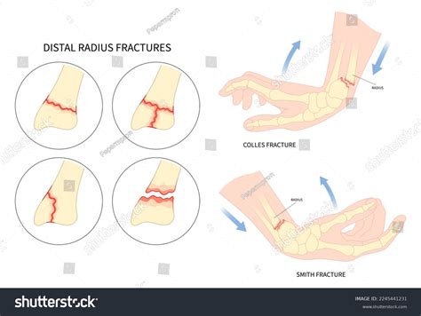 Anatomy Hand Radial Dislocated Avascular Necrosis Stock Vector Royalty