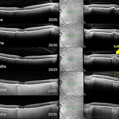 Serial Spectral Domain Optical Coherence Tomography Imaging From