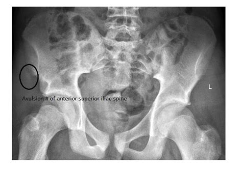 Anterior Inferior Iliac Spine Avulsion