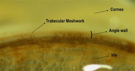 Gonioscopy Structures Gonioscopy Normal Angle 2 Gonioscopy Structures Gonioscopy Normal Angle 2