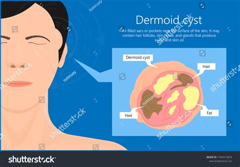 80 Imágenes De Dermoid Cyst Imágenes Fotos Y Vectores De Stock