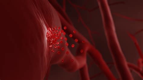 Med Journal 360 Inherited Bleeding Disorders Significantly Increase The Risk Of Postpartum