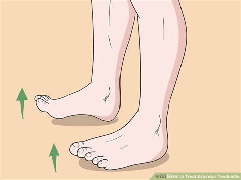 How To Treat Extensor Tendonitis 11 Steps With Pictures