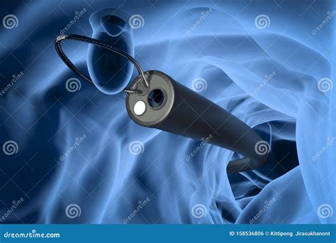 Endoscope Remove Colonic Polyp Stock Illustration Illustration Of Bowel Camera 158536806