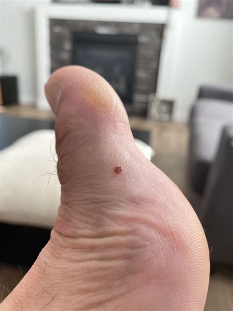 Advice On Scab That Isn T Healing R Medical Advice