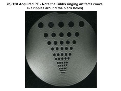 Mri Gibbs Ringing Artifact Reduction