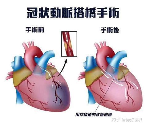 冠心病 通波仔vs搭桥怎么区别如何选择 知乎