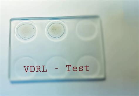 Vdrl Rpr For Syphilis