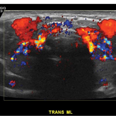 Transmidline Section Of The Thyroid Gland Ultrasound Revealing Download Scientific Diagram