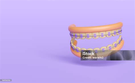 3d 치열 교정 만화 보라색 배경에 분리된 잇몸이 있는 치아 교정기 3d 렌더링 일러스트레이션 3차원 형태에 대한 스톡 사진 및 기타 이미지 Istock
